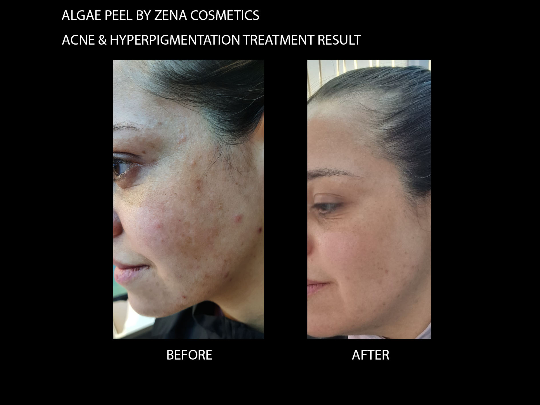Algae peeling Zena - Puerto Banus Nail Bar & Aesthetics Cork